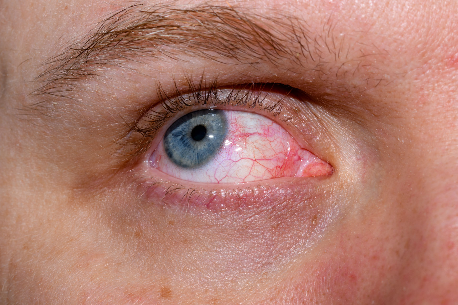 Wylew w oku – przyczyny i metody leczenia